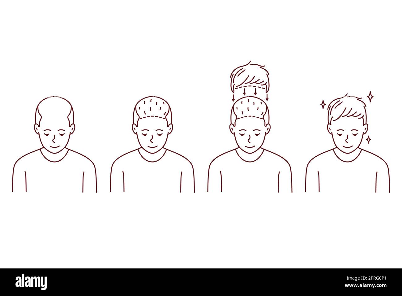 Stages On Man Hair Transplant Treatment Of Baldness And Alopecia Set