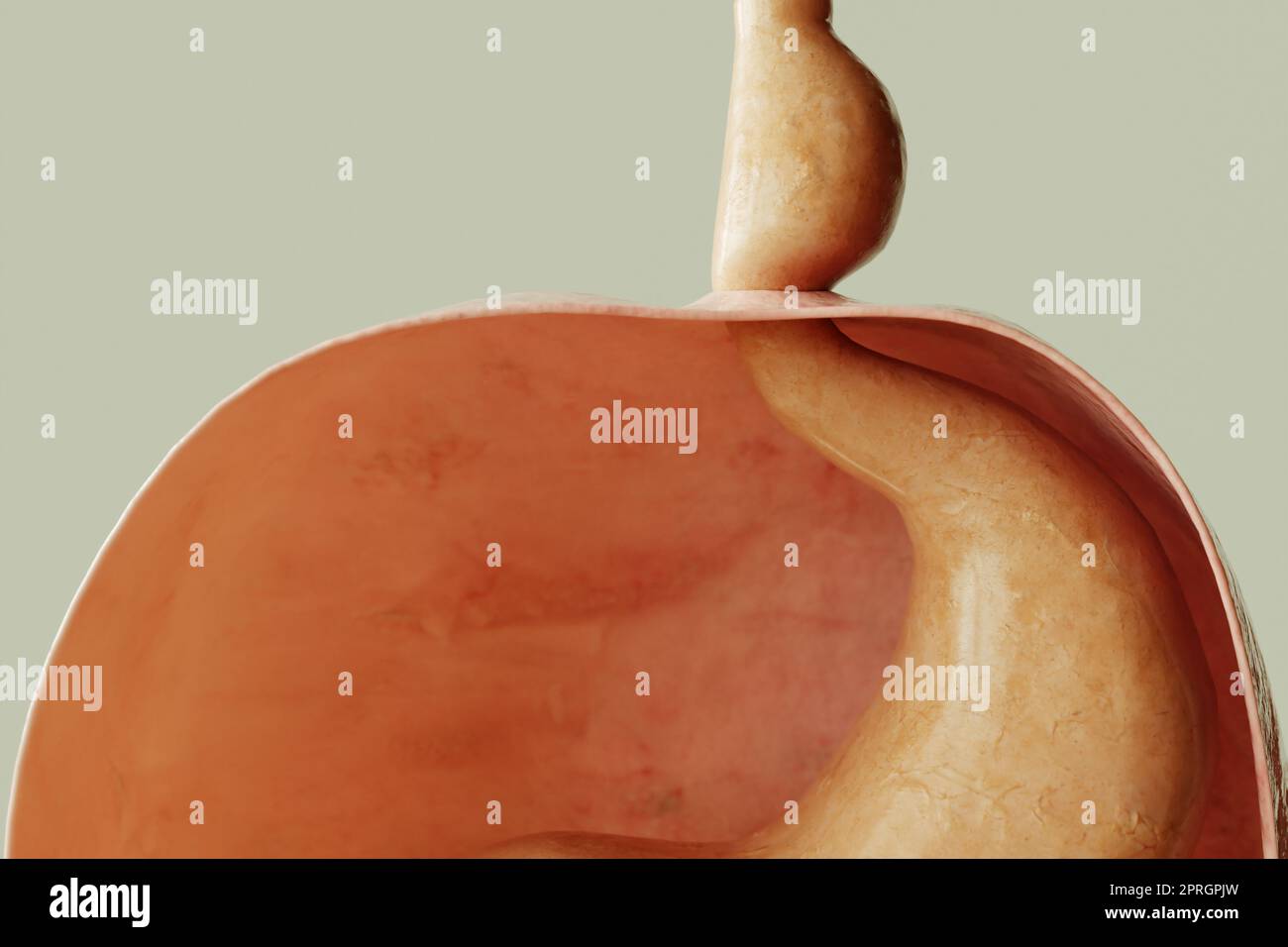 Hiatal hernia hi-res stock photography and images - Alamy