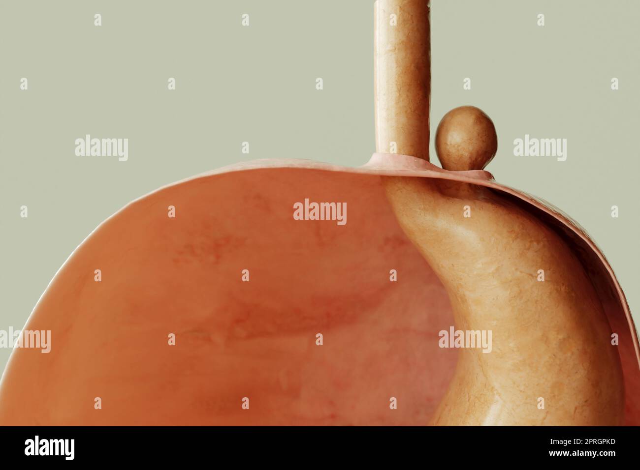 Paraesophageal Hiatus Hernia Type 2 - Stomach protrusion through ...