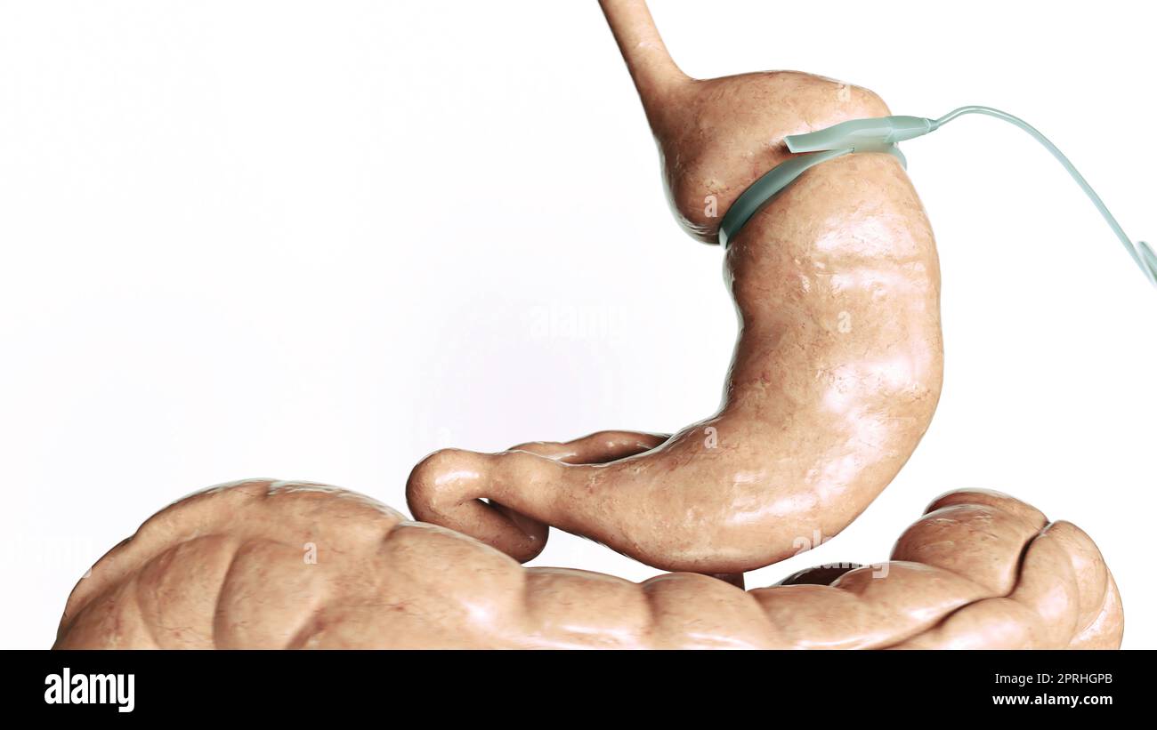 Stomach reduction 3 of 4- - Adjustable Gastric Band - AGB -- 3D Rendering Stock Photo - Alamy