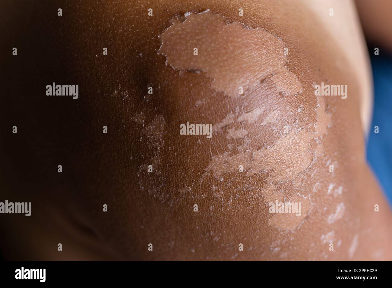 Male sunburned skin close up Stock Photo - Alamy