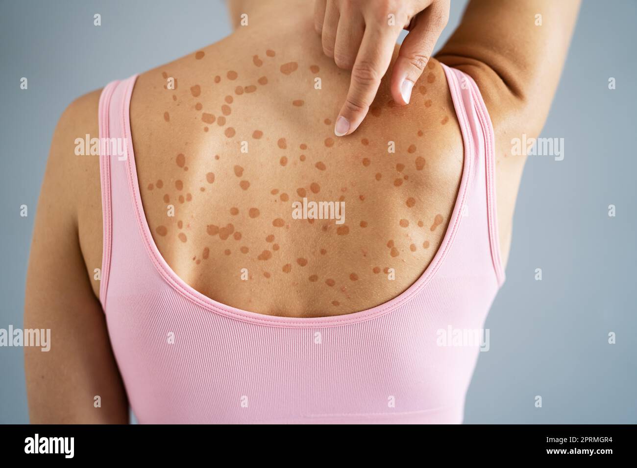 Woman Body Skin Rash With Red Allergy Eruption Stock Photo - Alamy