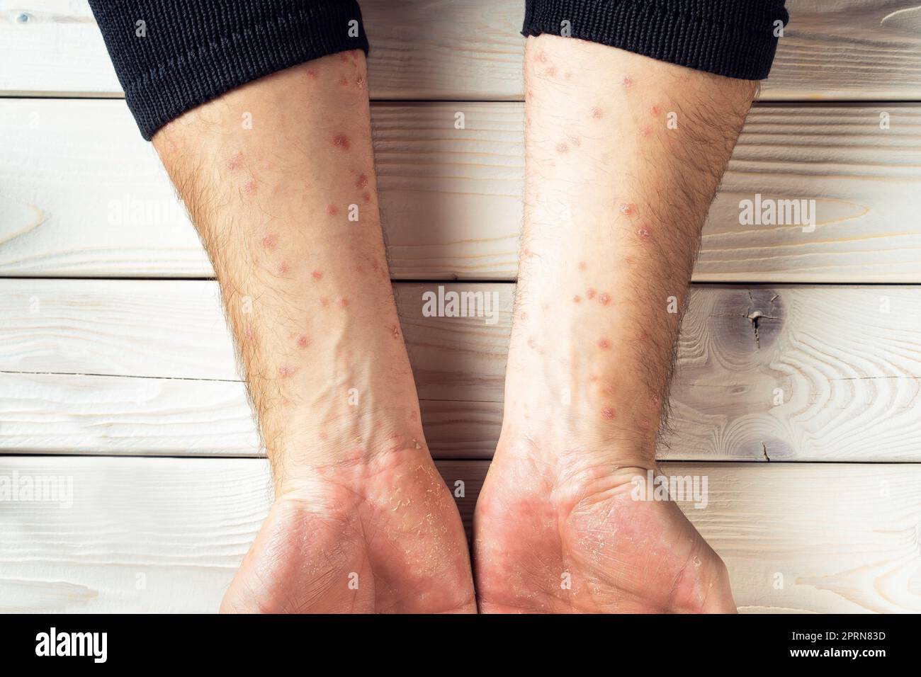 Top view of unrecognizable man suffering from psoriasis, showing thick ...