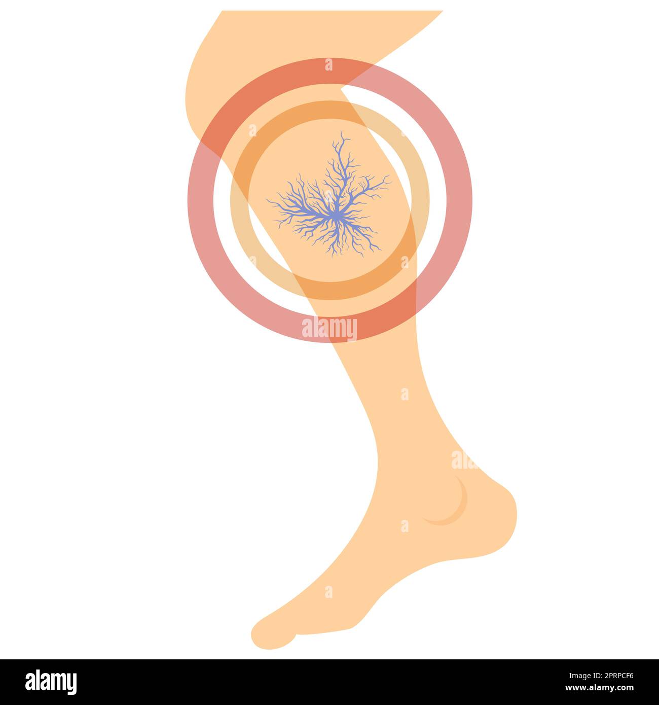 Spider Veins on Skin. Human Vessel, Health Arteries. Red Blood ...