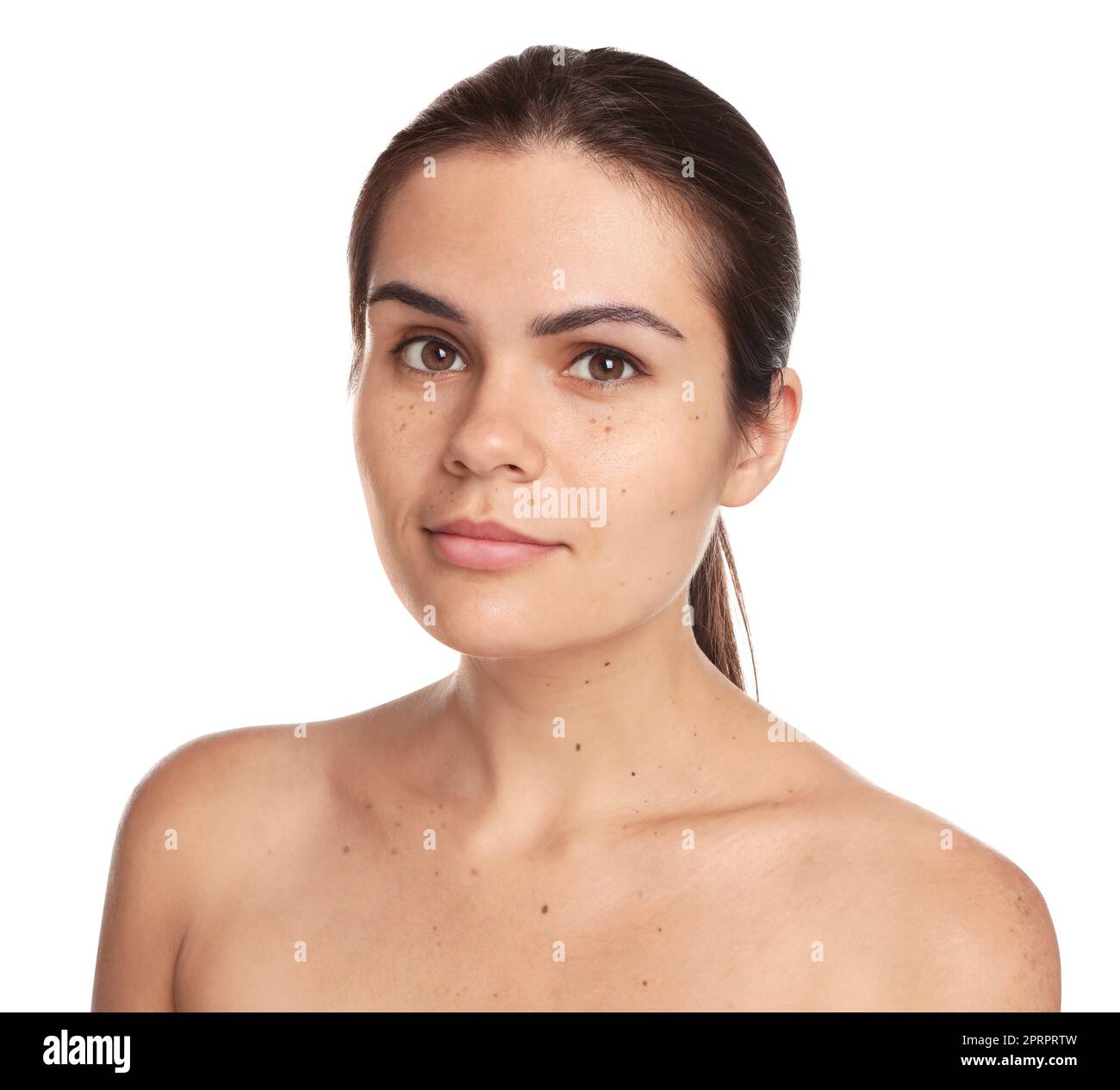 Beautiful woman with birthmarks on white background Stock Photo - Alamy