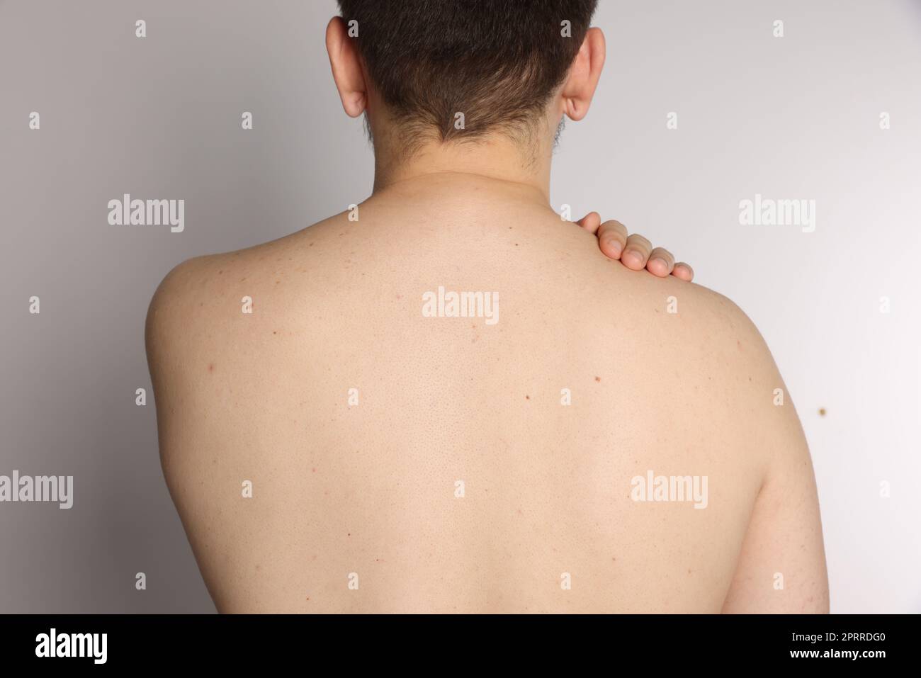 Closeup of man's body with birthmarks on light grey background, back ...