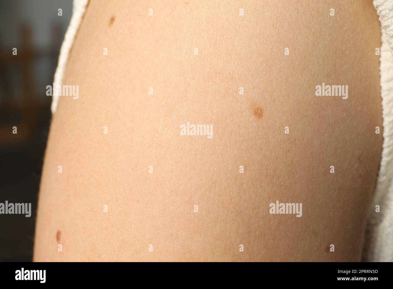 Closeup view of woman's body with birthmarks Stock Photo - Alamy