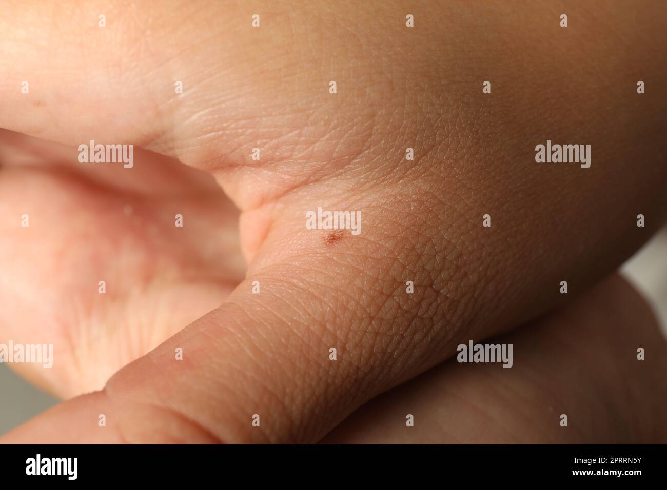 Hand closeup mole hi-res stock photography and images - Alamy