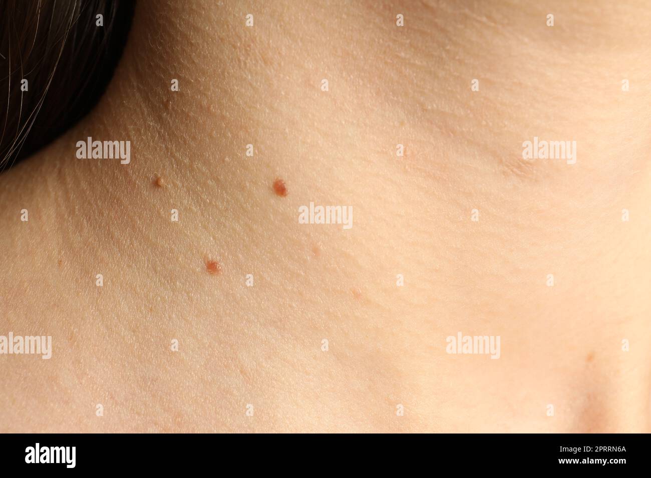 Closeup view of woman's body with birthmarks Stock Photo - Alamy