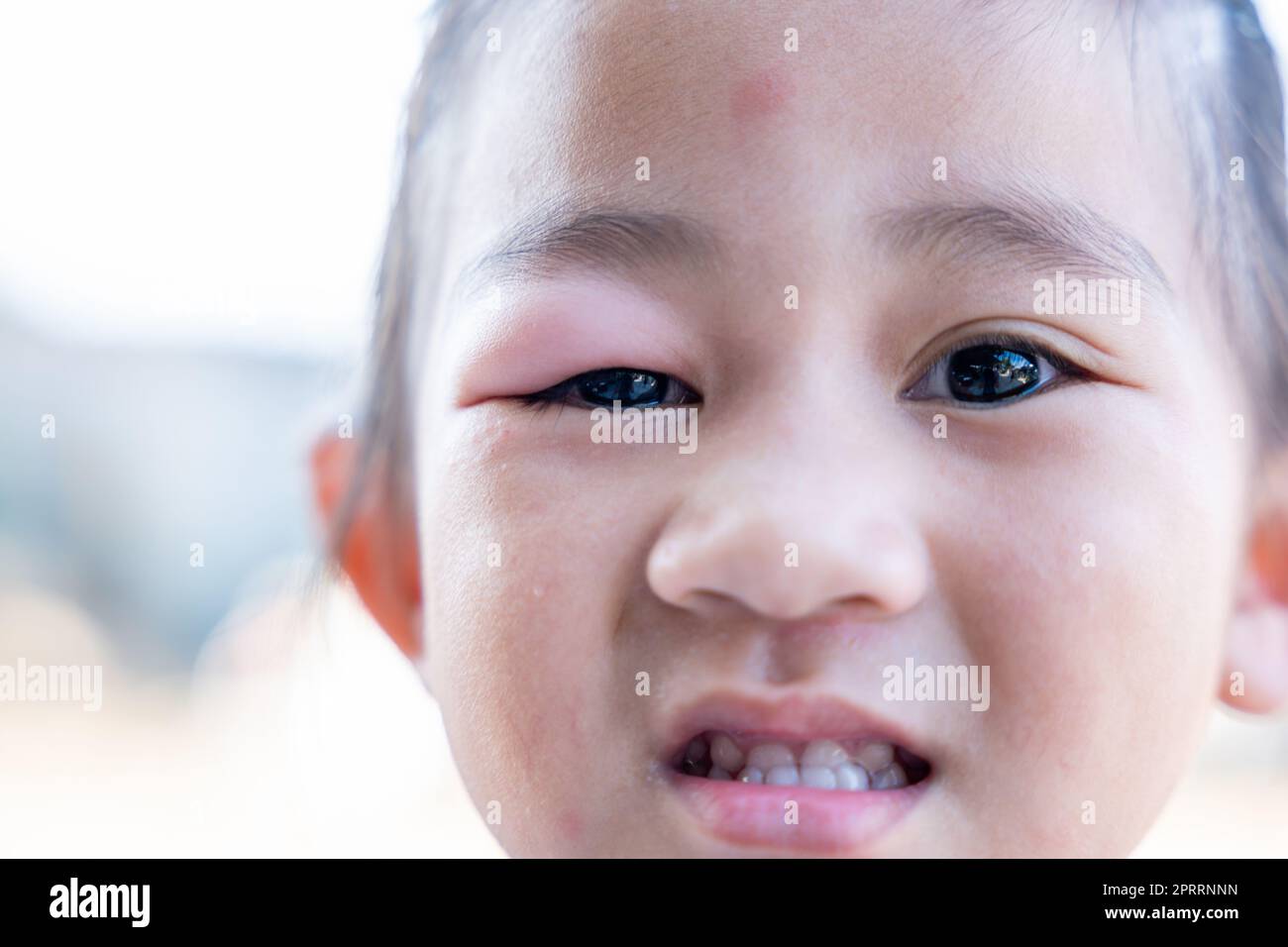 Sty eyelid hi-res stock photography and images - Alamy