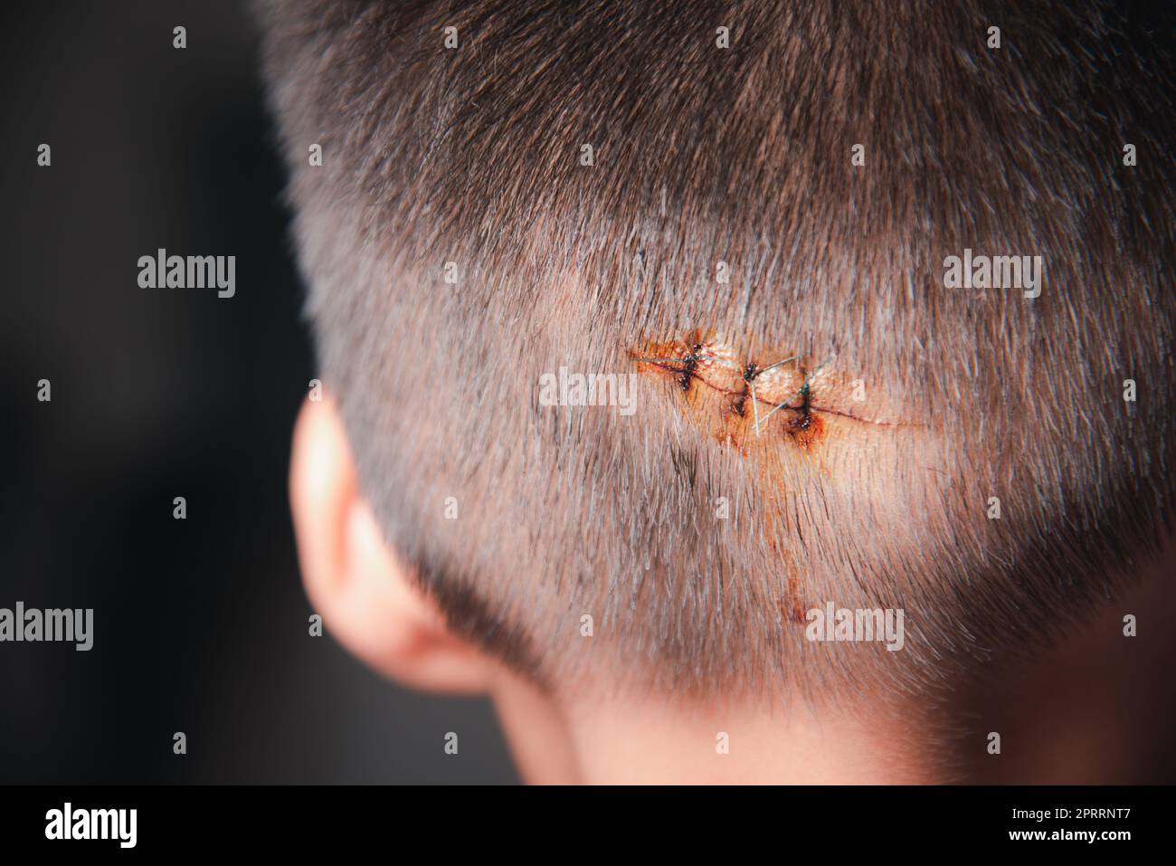 The lacerated suture wound of head which suture by nylion suture about ...