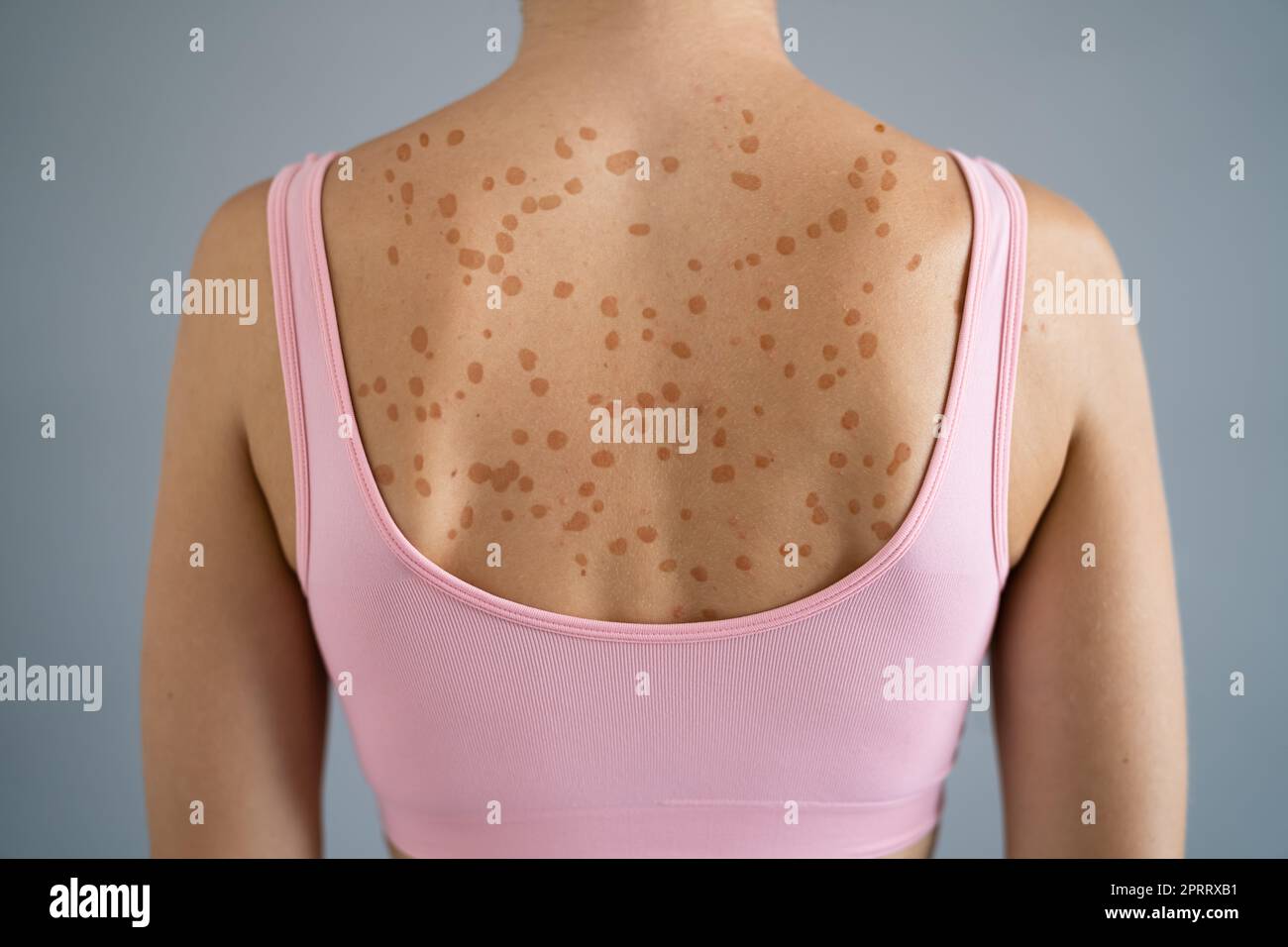 Woman Body Skin Rash With Red Allergy Eruption Stock Photo - Alamy