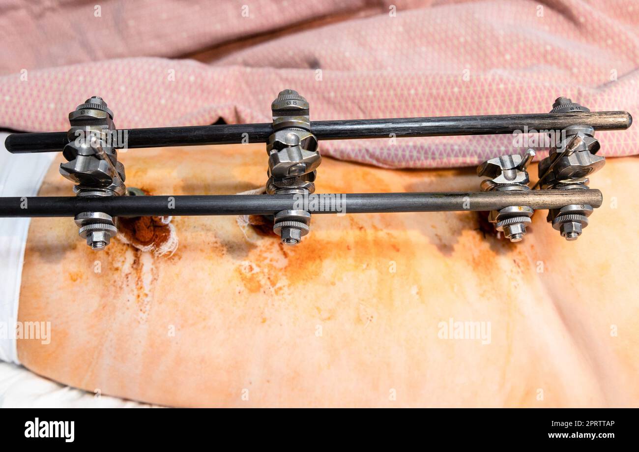 above view of external fixation device on hip and pelvic in patient ...