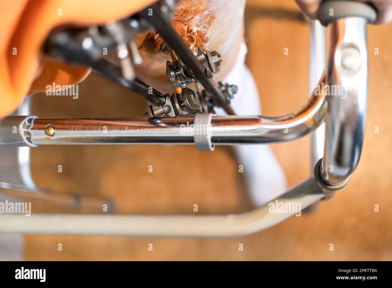 above view of external fixation device on hip and pelvic in patient ...
