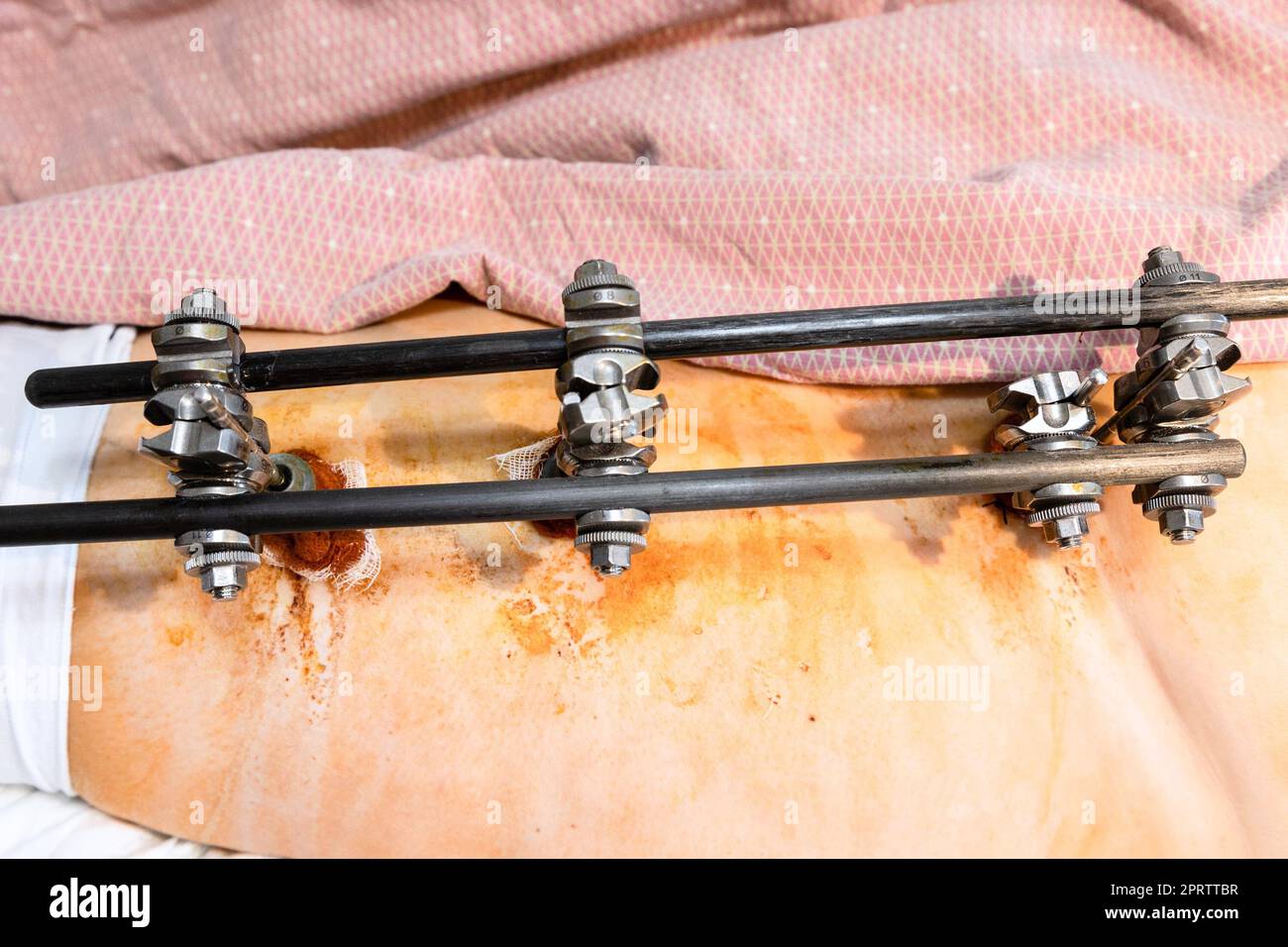 View Of External Fixation Device On Hip And Pelvic In Patient With Pelvic Fracture Focus On