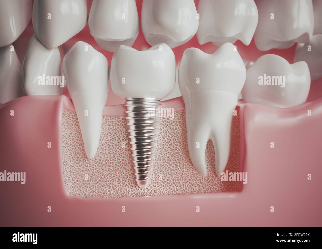 Implant next to a healthy molar -- 3D rendering Stock Photo - Alamy