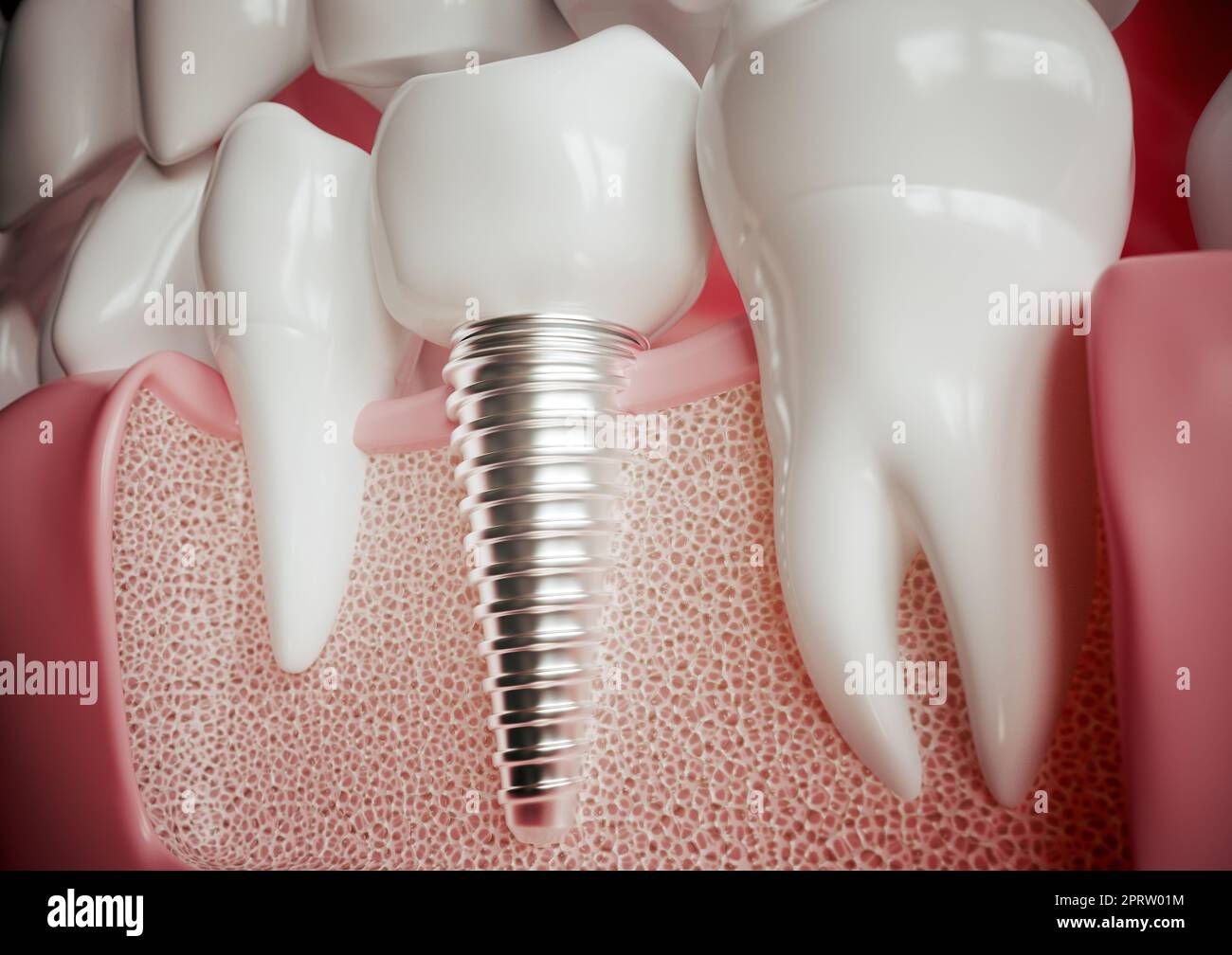 Implant next to a healthy molar -- 3D rendering Stock Photo - Alamy