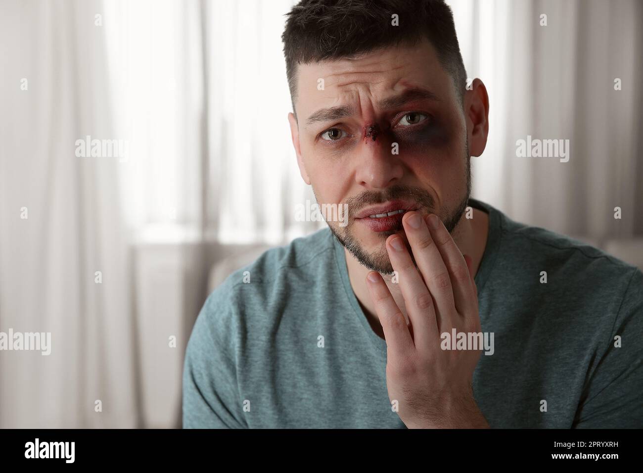 Man with facial injuries at home, space for text. Domestic violence ...