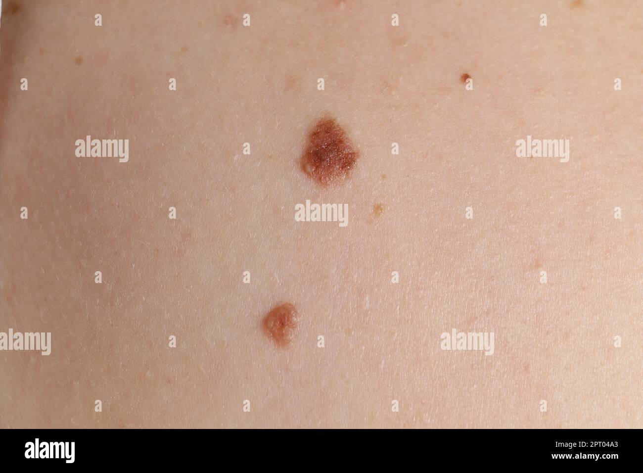 Closeup view of woman's body with birthmarks as background Stock Photo ...