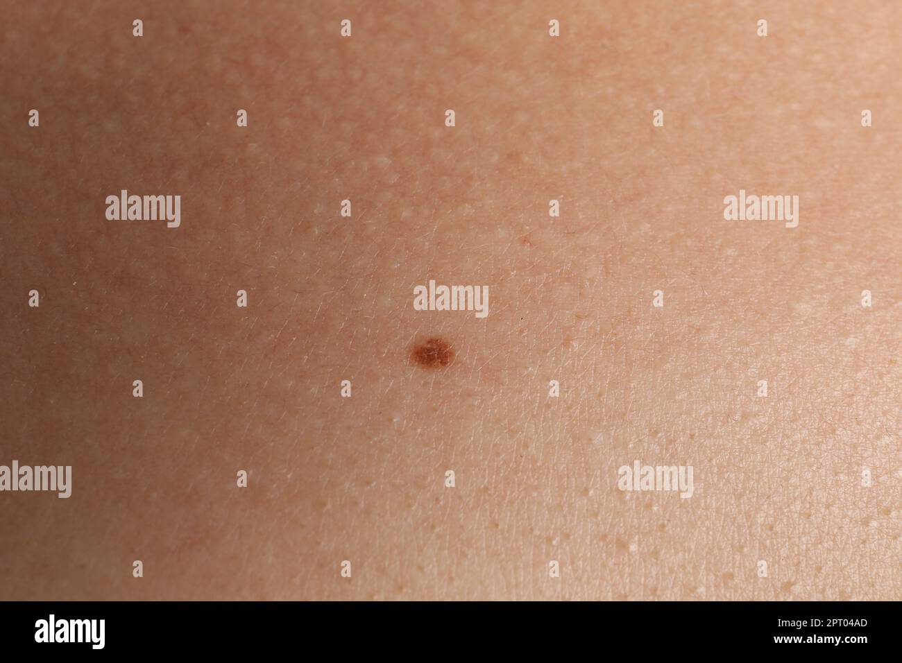Closeup view of woman's body with birthmark Stock Photo - Alamy
