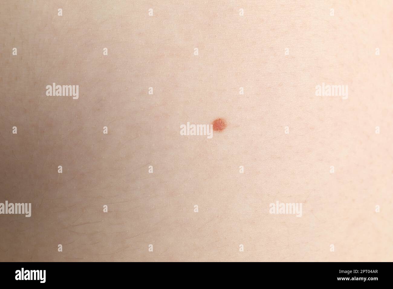 Closeup view of woman's body with birthmark Stock Photo - Alamy