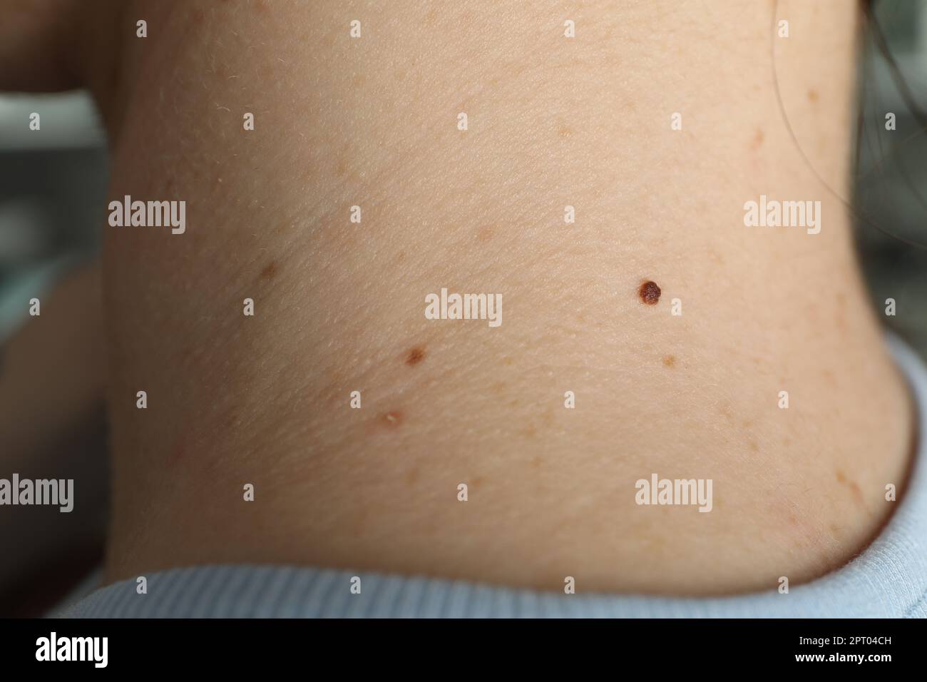 Closeup view of woman's body with birthmarks Stock Photo - Alamy