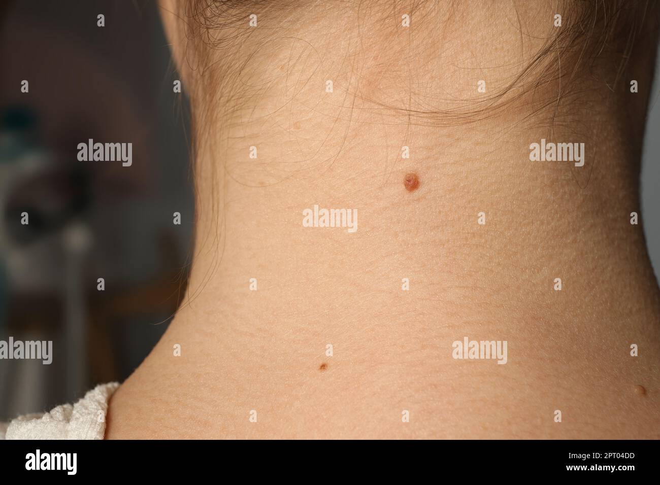 Closeup view of woman's neck with birthmarks Stock Photo - Alamy