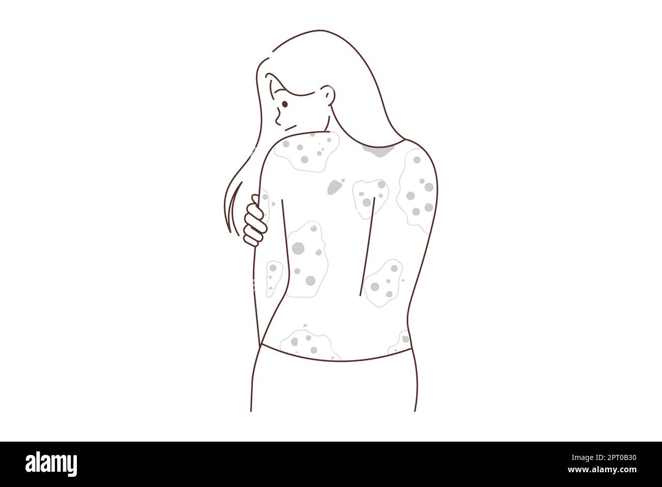 Unhealthy woman showing red rash on back suffer from dermatitis. Unwell ...