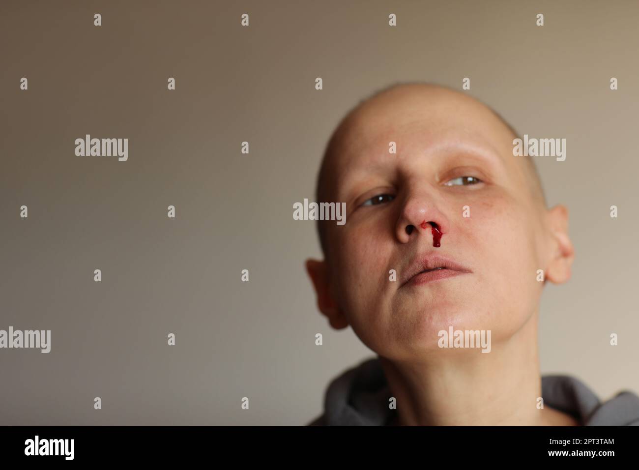 Cancer Bald