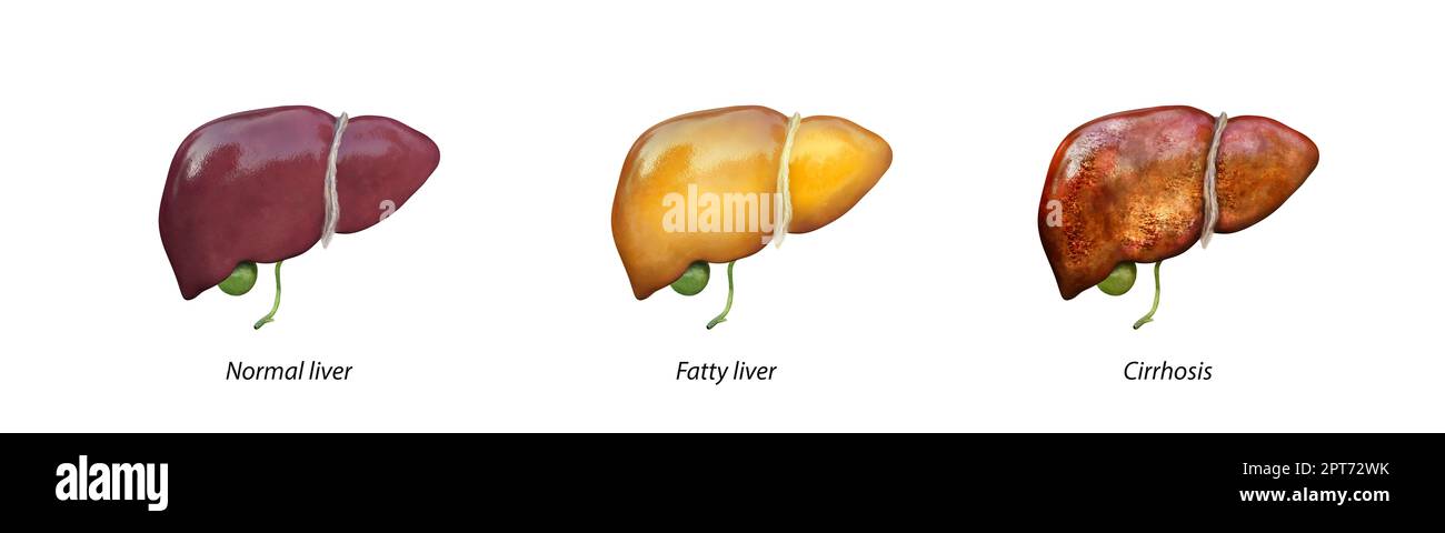 Normal liver versus liver with Cirrhosis, damaged liver, excessive ...