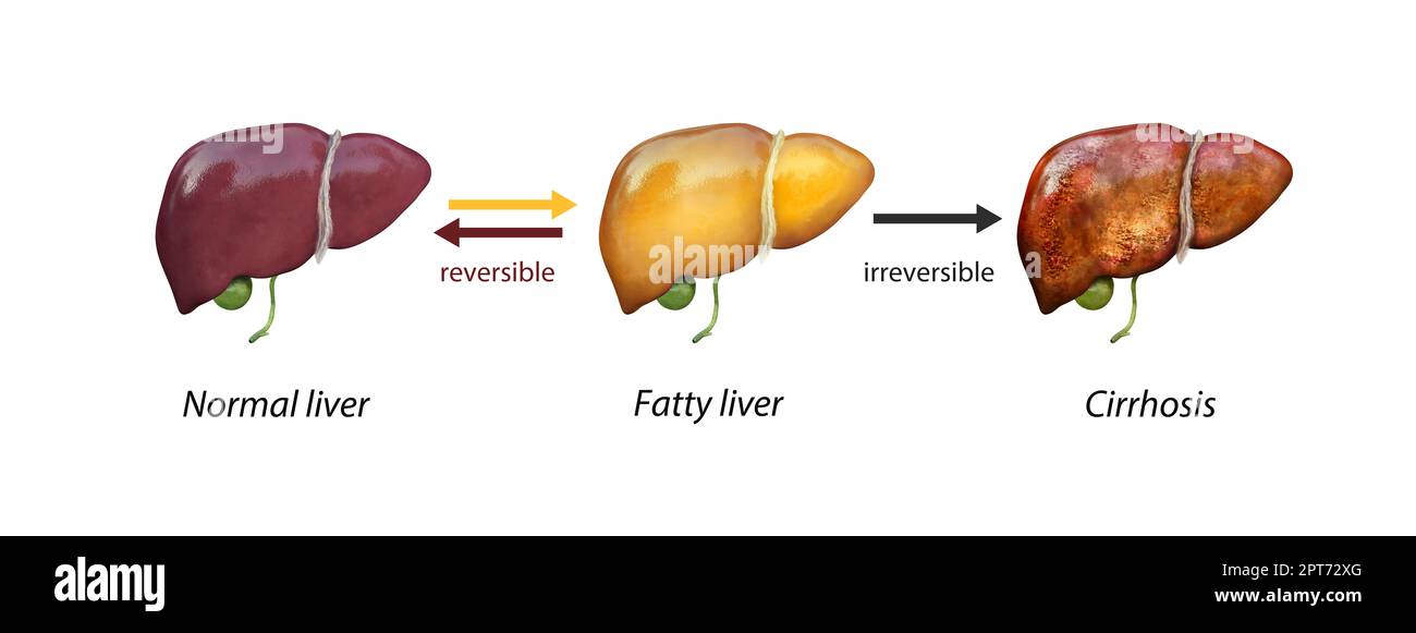 Normal liver versus liver with Cirrhosis, damaged liver,fatty liver ...