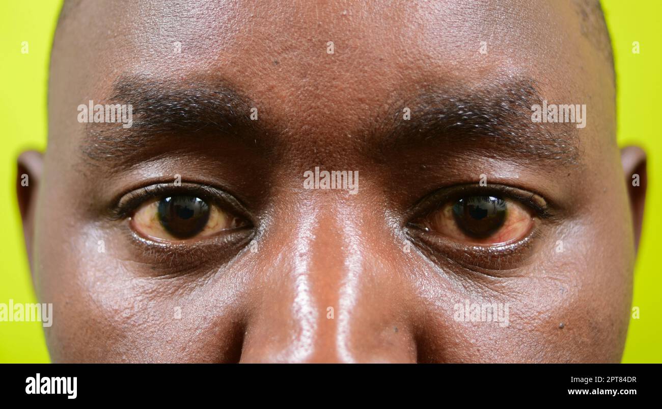 Red eye clos-up with conjunctivitis, black man red eye Stock Photo - Alamy