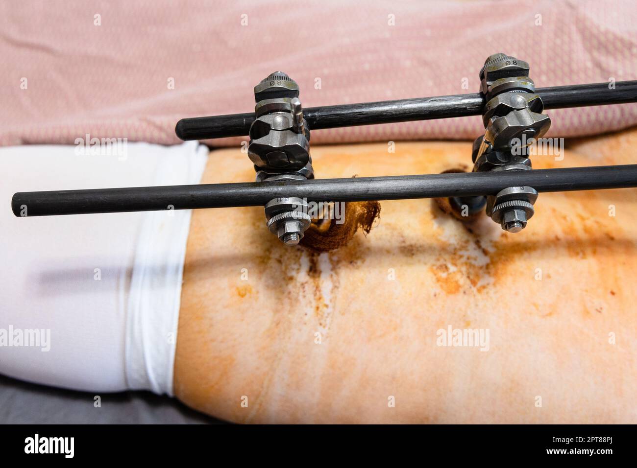 External Fixation Device On Hip In Patient With Pelvic Fracture Focus On The Foreground Rod