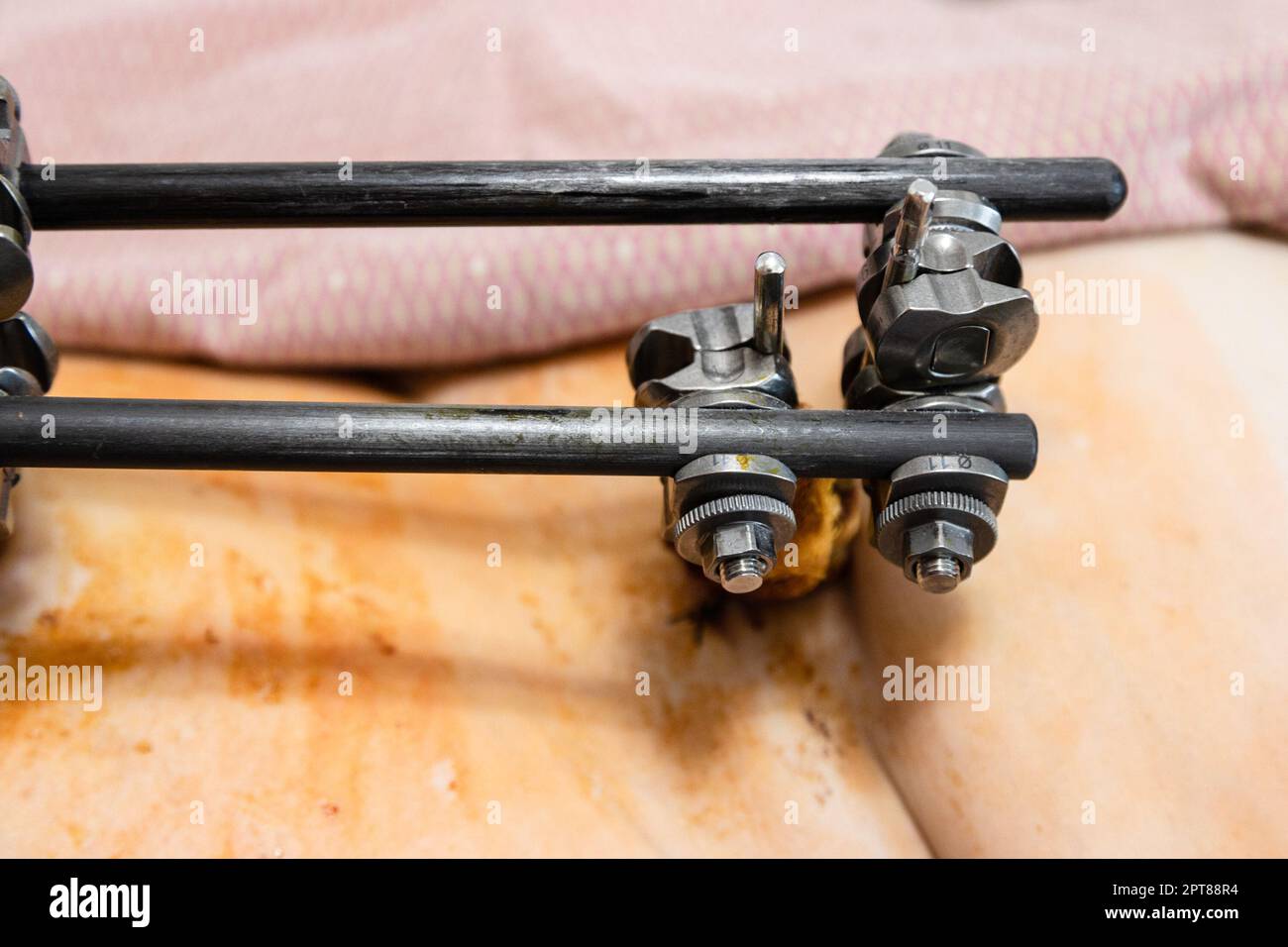 external fixation device on pelvic close up in patient with pelvic ...