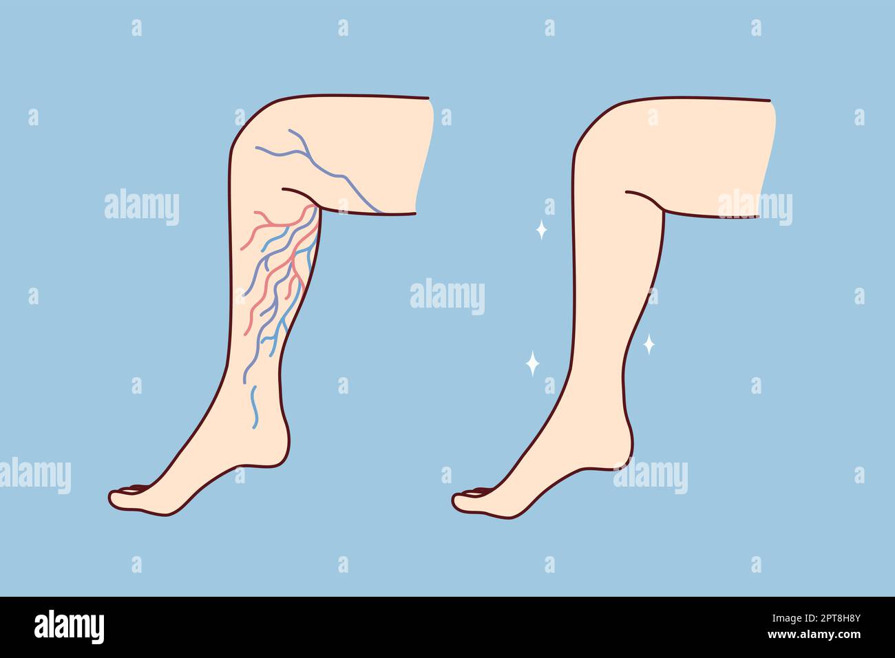 Thrombosis leg Stock Vector Images - Alamy