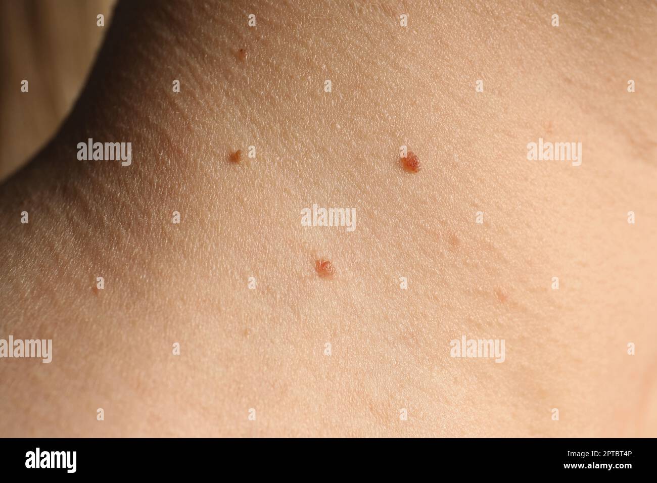 Closeup view of woman's body with birthmarks Stock Photo - Alamy