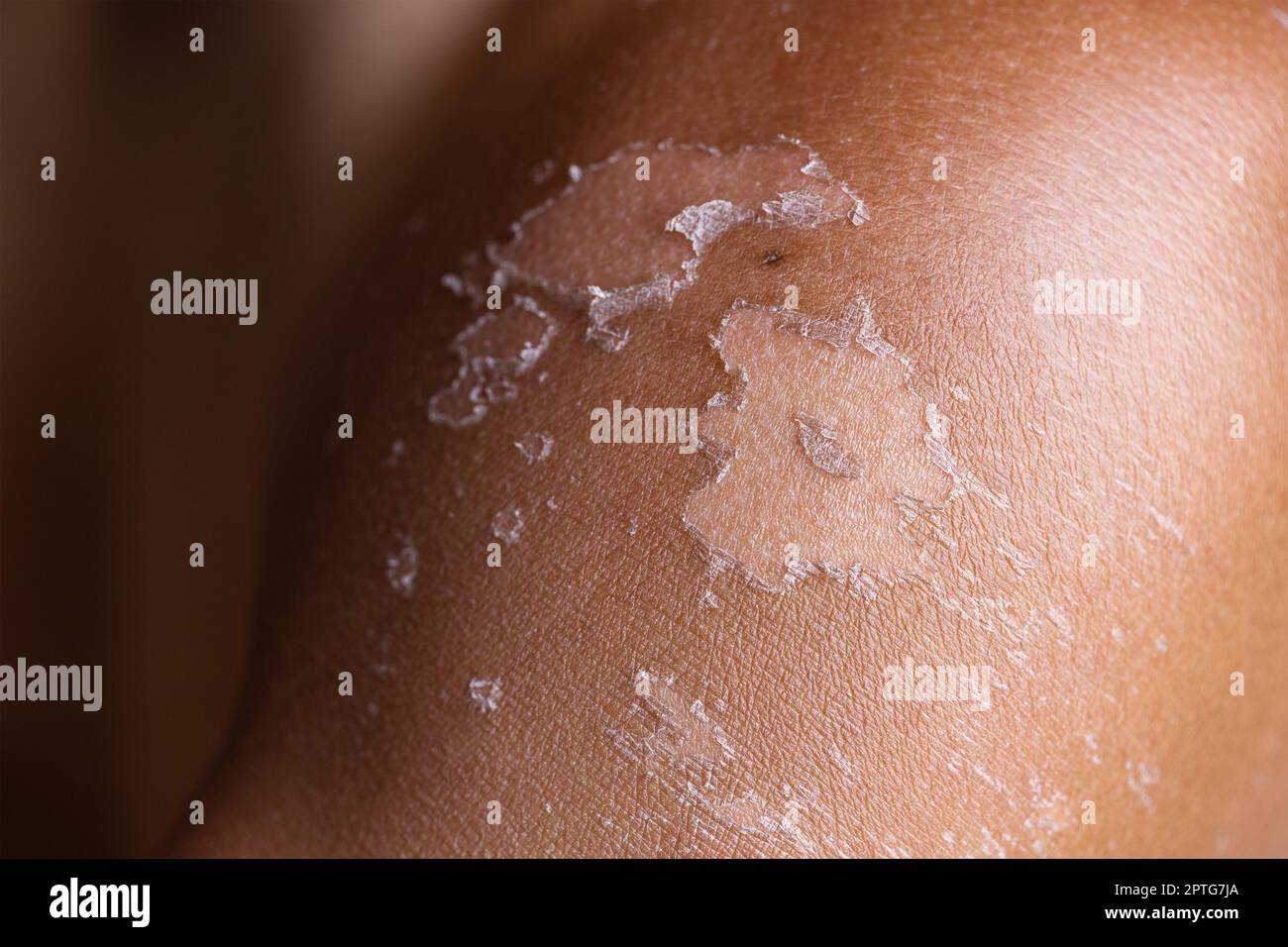 Male sunburned skin close up Stock Photo - Alamy