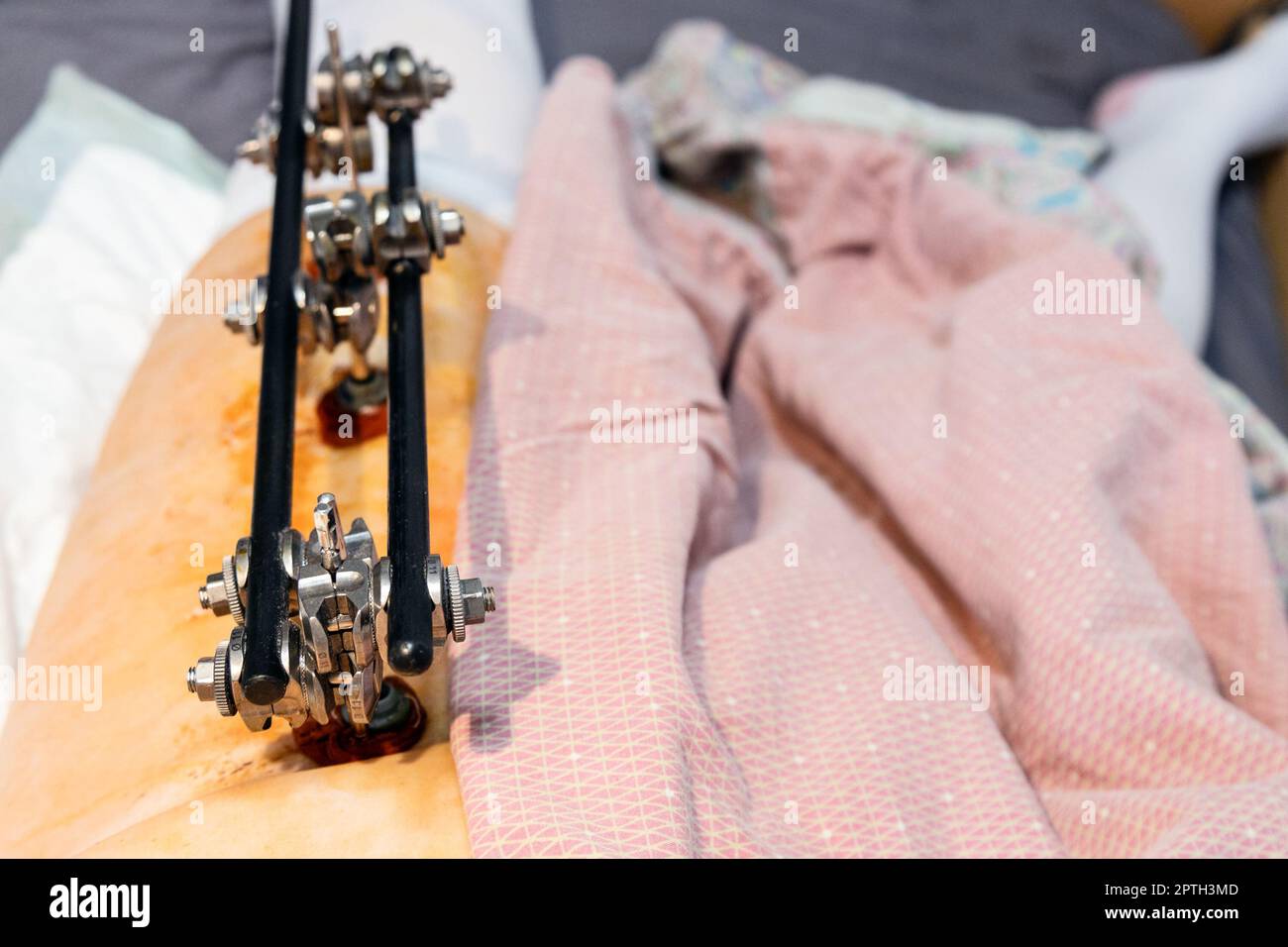 pov view of external fixation device on hip and pelvic in patient with ...