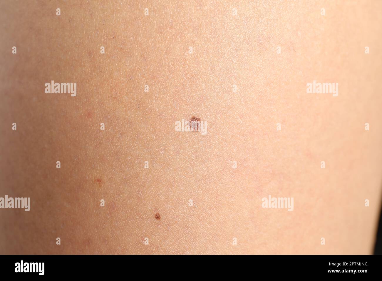 Closeup view of woman's body with birthmarks Stock Photo - Alamy