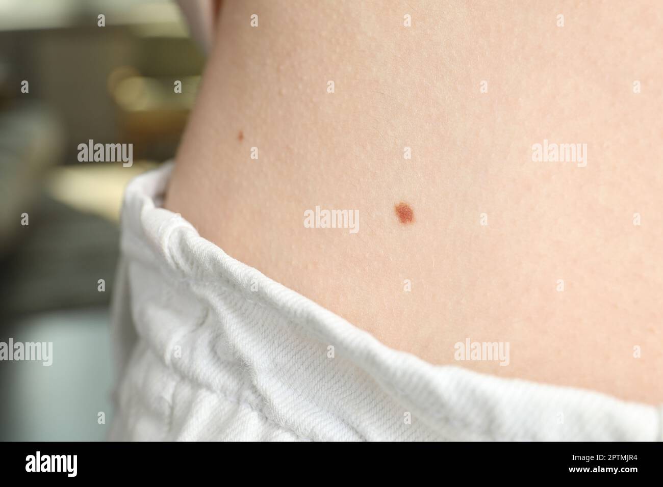 Closeup view of woman's body with birthmarks Stock Photo - Alamy