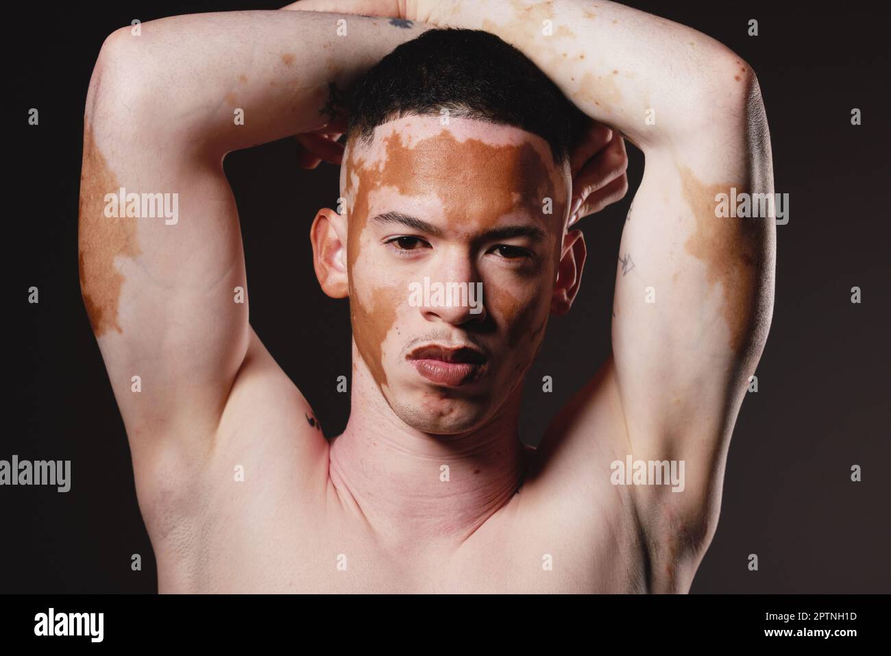 Vitiligo male model hi-res stock photography and images - Alamy