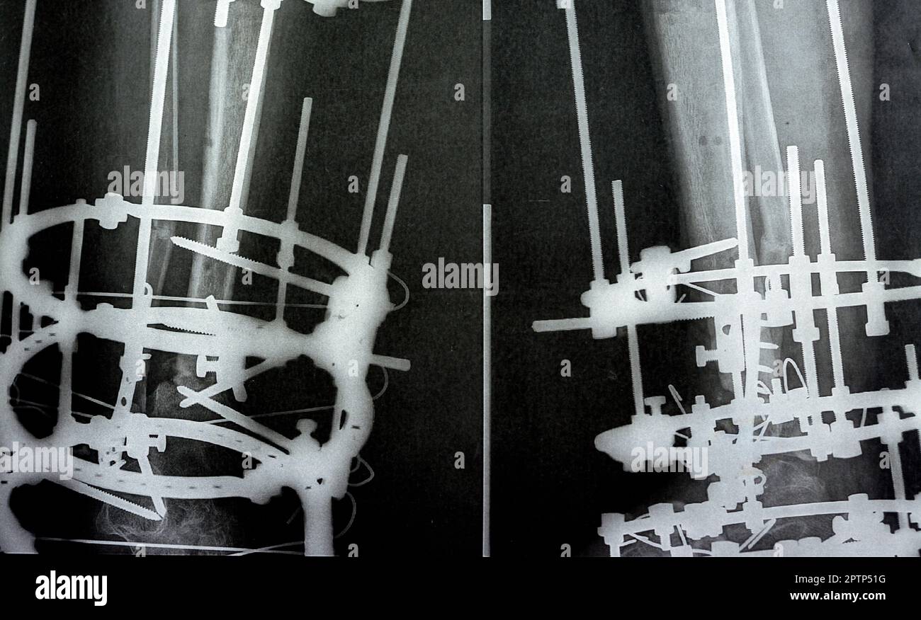 Distal comminuted fracture fibula managed by plate and screws, distal ...