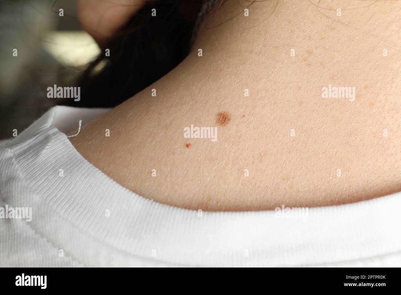 Closeup view of woman's body with birthmarks Stock Photo - Alamy