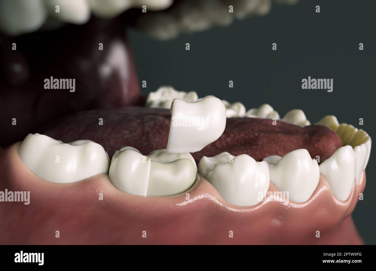Ceramic Onlay quarter crown over a tooth- 3D Rendering Stock Photo - Alamy