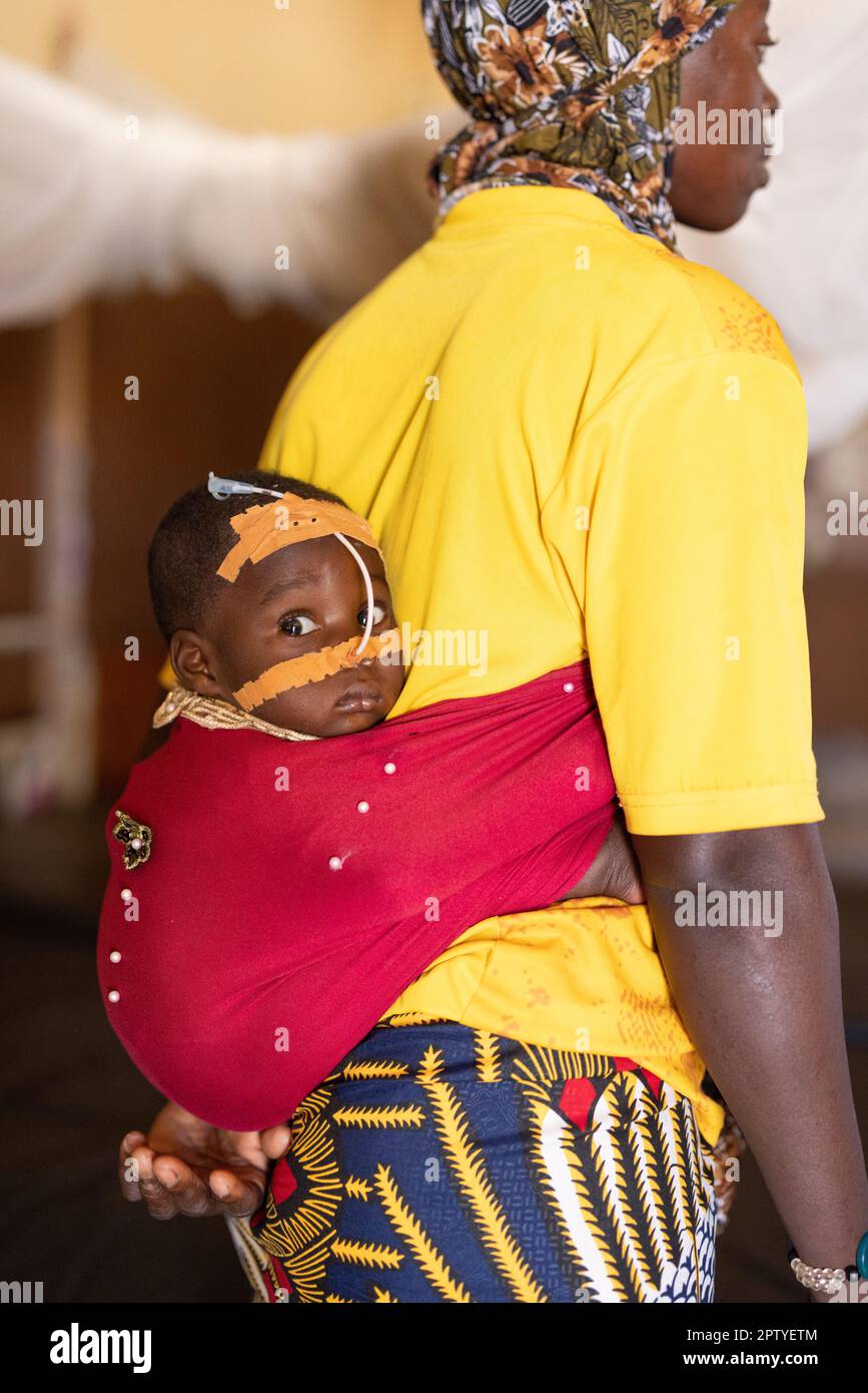 A mother carries her malnourished baby on her back in the malnutrition ...