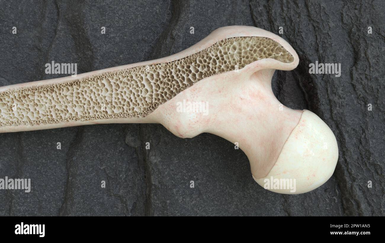 Brittle bone disease normal bones hi-res stock photography and images ...