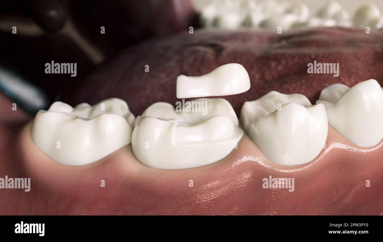 Ceramic Onlay quarter crown over a tooth- 3D Rendering Stock Photo - Alamy