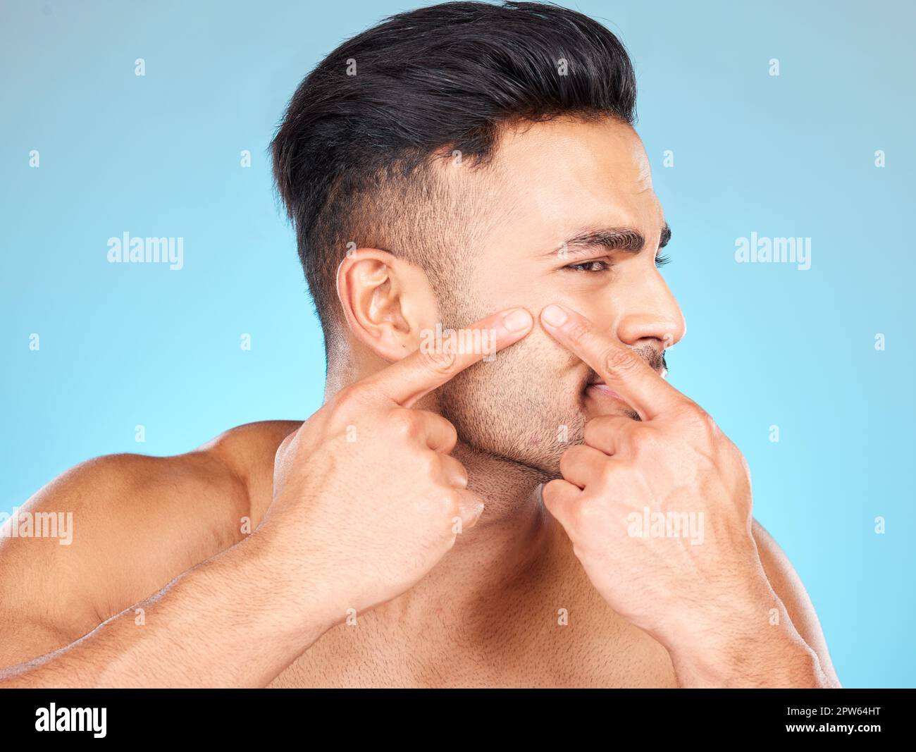Man, hands and pop acne of face for skincare, beauty wellness or skin ...