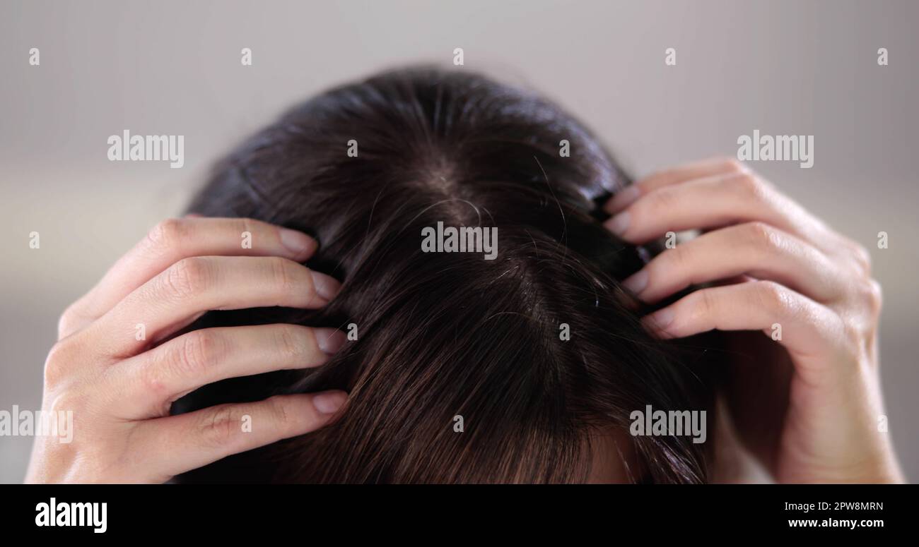 Hair Dandruff And Itchy Scalp Problem Treatment Stock Photo - Alamy