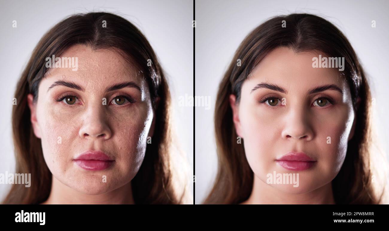 Before After Young Girl Face Wrinkle Treatment Stock Photo - Alamy